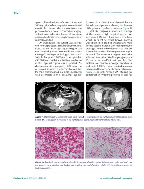 Extrapulmonary Tuberculosis Presents As A Groin Abscess Pdf