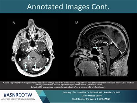 The American Society Of Neuroradiology On Twitter Hard One Everyone Answer Neurosarcoidosis