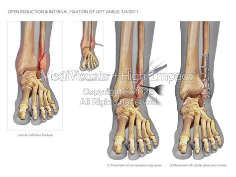 Open Reduction And Internal Fixation Of Left Ankle Medivisuals High Impact