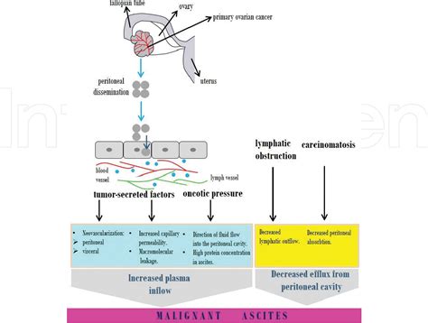 Is Ascites A Sign Of Advanced Ovarian Cancer Cancerwalls