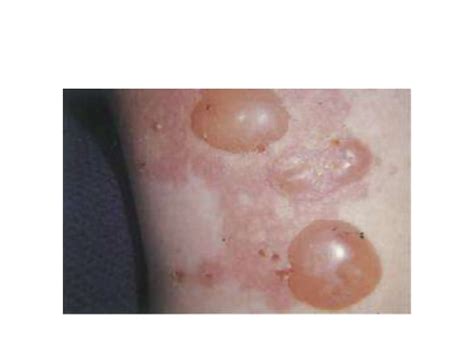 Bullous Disease Of The Skinpptx