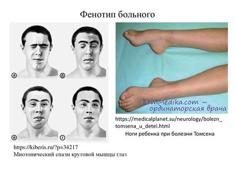 Врожденная миотония Томсена Миотоническая дистрофия презентация онлайн