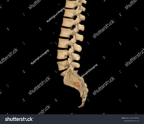 Ct Scan Lumbar Spine 3d Rendering Stock Illustration 2227478935