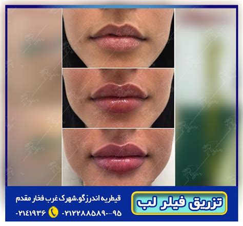 فرم دهی لب با تزریق ژل هیالونیک اسید با بیحسی و کاملا بدون درد