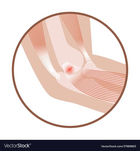 Medial Epicondylitis Golfer Elbow Royalty Free Vector Image