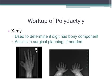 Ppt Polydactyly Powerpoint Presentation Free Download Id3383975