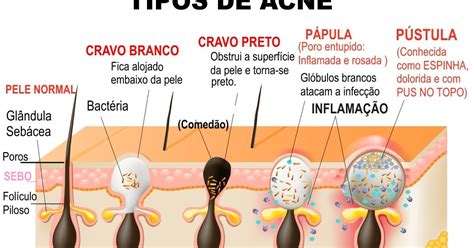 Esthetic SFernandes Tipos De Acne