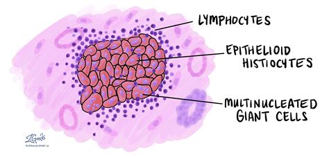 Non Necrotizing Granulomatous Inflammation Mypathologyreport Ca