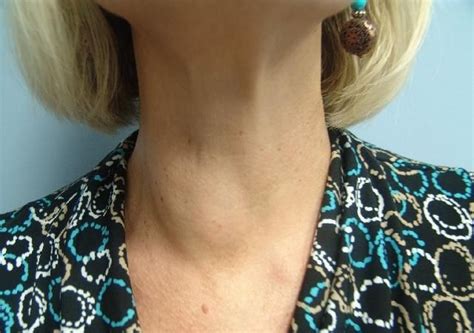 Киста щитовидной железы опасно ли это Лечение кисты щитовидной железы