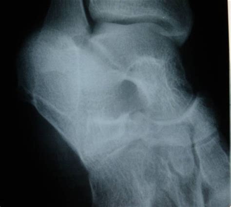 Tarsal Coalition Pediatrics Orthobullets