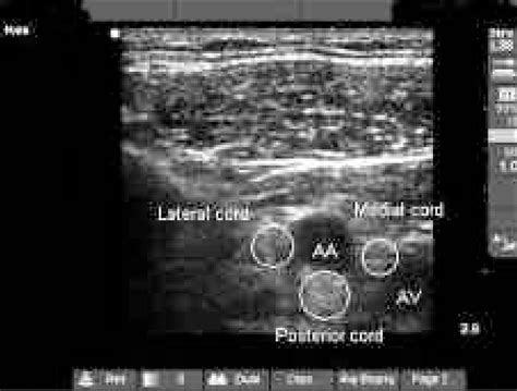 Nerves As Seen On Ultrasound In Infraclavicular Area AA Axillary