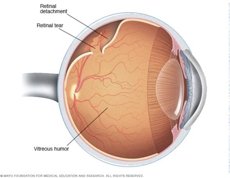 ISITZEN Retinal Detachment