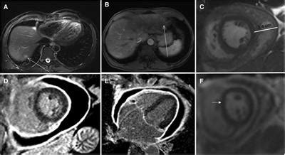 Frontiers Case Report Acute Pericarditis Following Hepatic Microwave