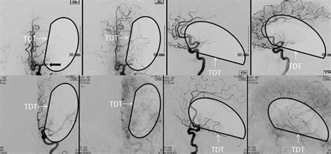 Recommendations On Angiographic Revascularization Grading Standards For