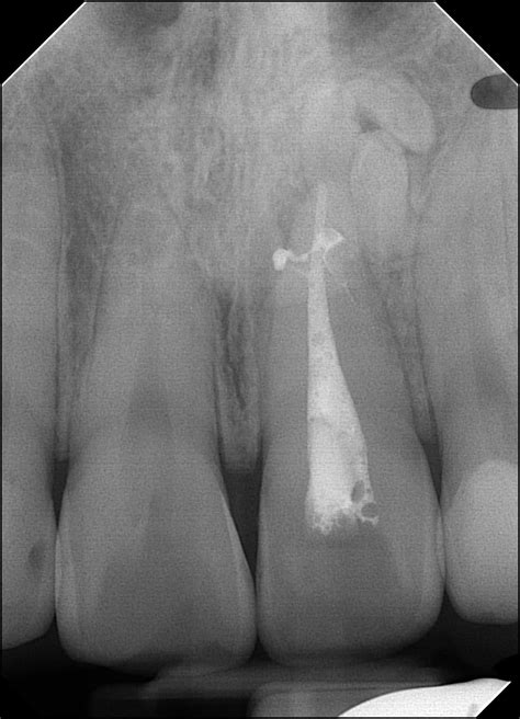 Root Canal Before And After Image Gallery Root Canal Nyc