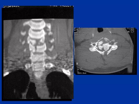 Cervical Spine Injury C Spine Clearing The Cervical Spine Ppt