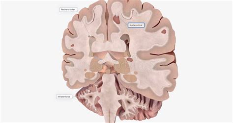 Cerebellum Lesions Stock Illustrations 14 Cerebellum Lesions Stock