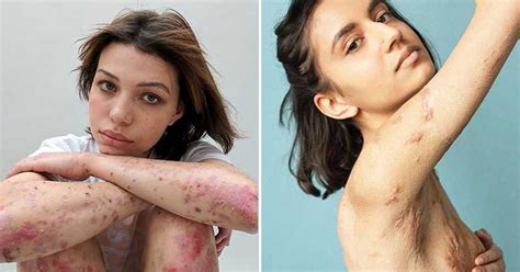 People Reveal Their Scars And How They Got Them In A Powerful Photo Project