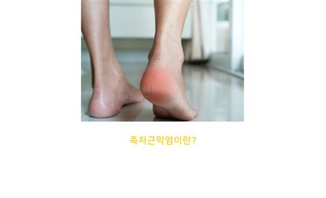 웰본정형외과 족저근막염