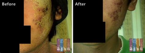 농포성건선 치료 네이버 블로그