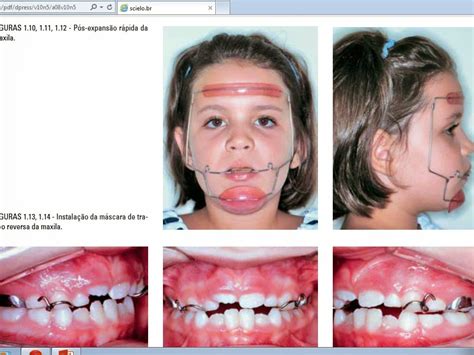Blog De Ortodontia Por Dra Amanda Borges DiagnÓstico E Tratamento Do