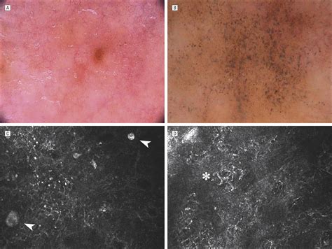Pagets Disease Breast Metastasis At Harold Spence Blog
