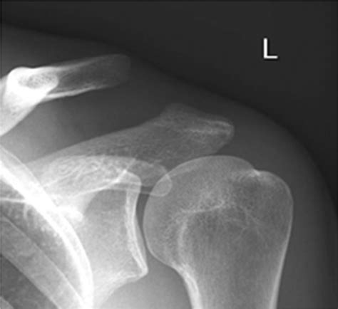Ukuzivocavoca Okungavumelekanga Emva Kwe Acromioclavicular Dislocation