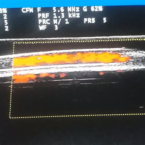 Ultrasound Guided Picc Placement Training Model Medtaceud