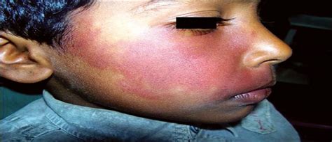 Capillary Hemangioma Or Pyogenic Granuloma A Diagnostic Dil