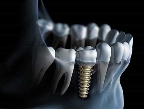 Implants Still An Option Years After Tooth Loss