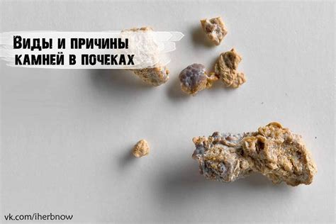 Почему в почках образуются камни все причины