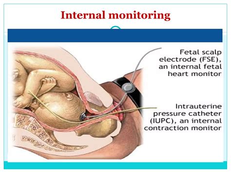 Fetal Monitoring For Undergraduate Ppt