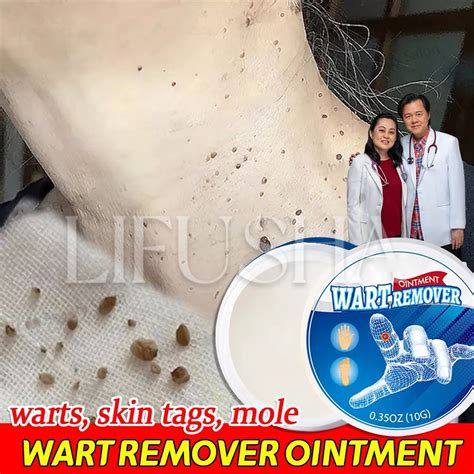 Warts Remover Original Cream Skin Tag Kulugo Mole Remover Cream Warts