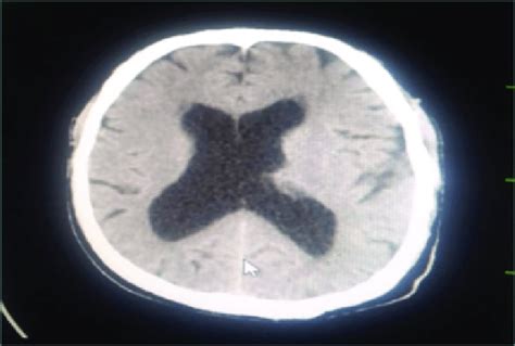 Computerized Tomography Scan Of Brain Showing Disproportional