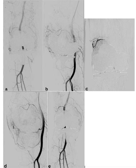 Geniculate Artery Embolization A Review Of Hemarthrosis And Osteoarthritis