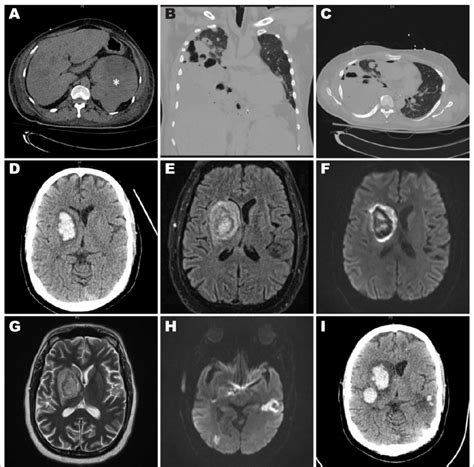 Unenhanced Computed Tomography Scans Transverse View A Of The