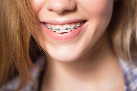 Guidance On Caring For Your Teeth With Braces From Dr Justin Liggett
