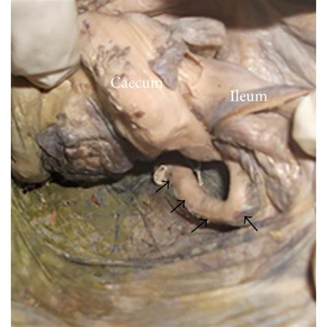 Position Of The Appendix Arrow A Retrocecal Appendix Note The Download Scientific Diagram