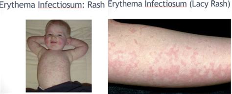 Reticular Rash Fifth Disease
