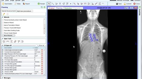 Spine Assessment In The Ap Or Pa View Spine Materialise Orthoview