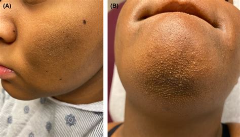 Follicular Hyperkeratosis