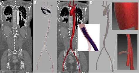 Patient Specific Computational Modeling Of Different Cannula Asaio