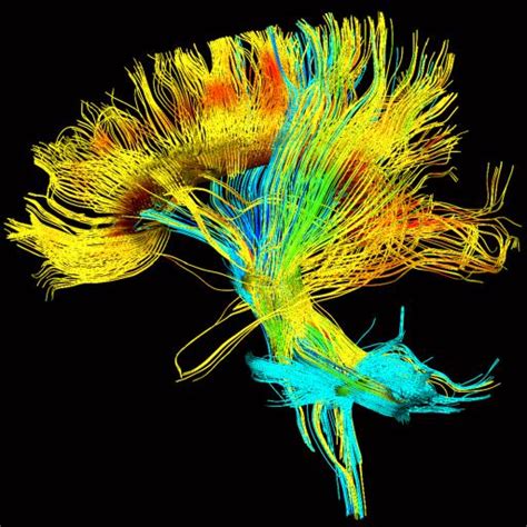 Dti Tractography