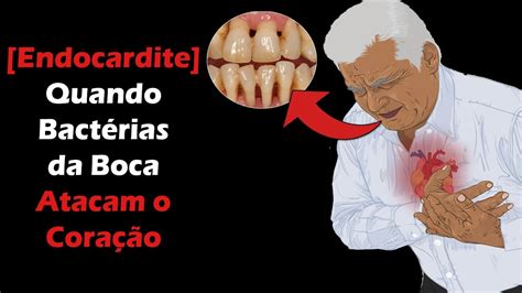 Endocardite Bacteriana Causas E Sintomas Da Infecção Cardíaca Por