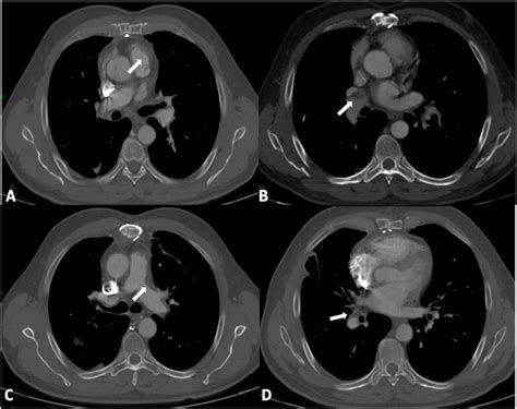 Recurrence And Progression Of Pais After Surgical Resection Staging