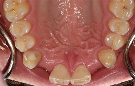 Implant Planning Using Ez D I And Ez D Plus And Greenct