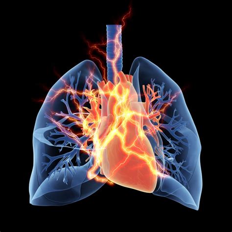 Exercise For Pulmonary Hypertension