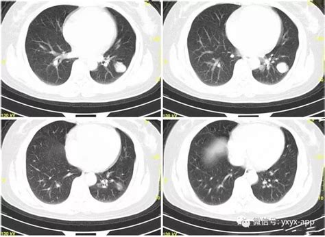 【病例】肺错构瘤1例ct影像表现 影像ppt