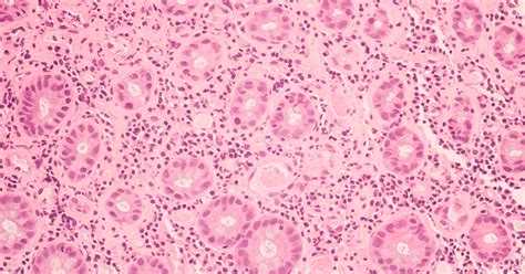 Understanding Your Breast Cancer Hormone Receptor Status A Guide For