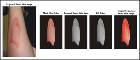 Normal First Degree Segmentation Results Download Scientific Diagram